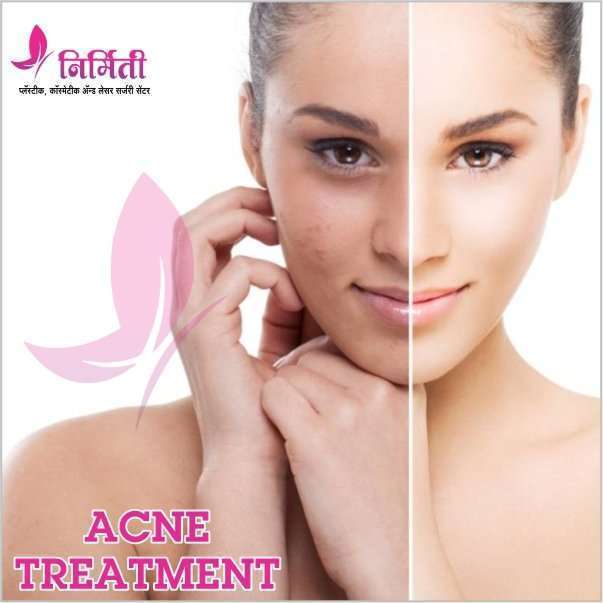Effective Acne Pimple Treatment In Kolhapur Sangli Effective Acne Pimple Treatment In Kolhapur Sangli