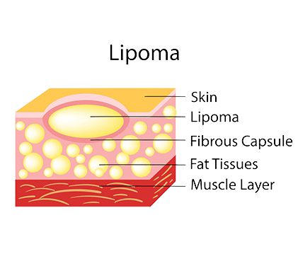 Multiple Lipoma Treatment | Lipoma Treatment Kolhapur